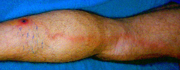 Conduite à tenir lors d’une piqûre de tique – IHU